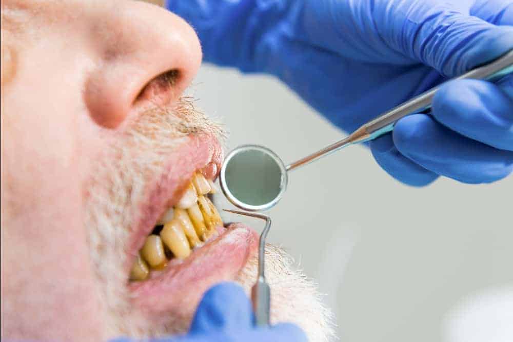 What Are Heroin Teeth? - Guardian Recovery