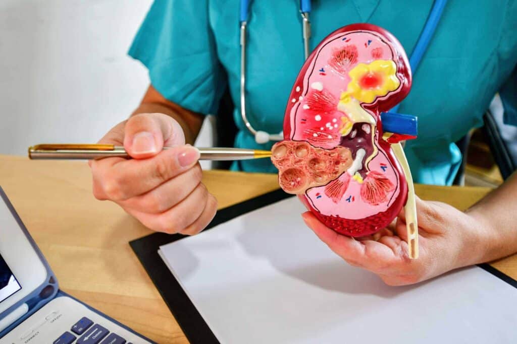 Can Alcohol Cause Kidney Stones? - Guardian Recovery